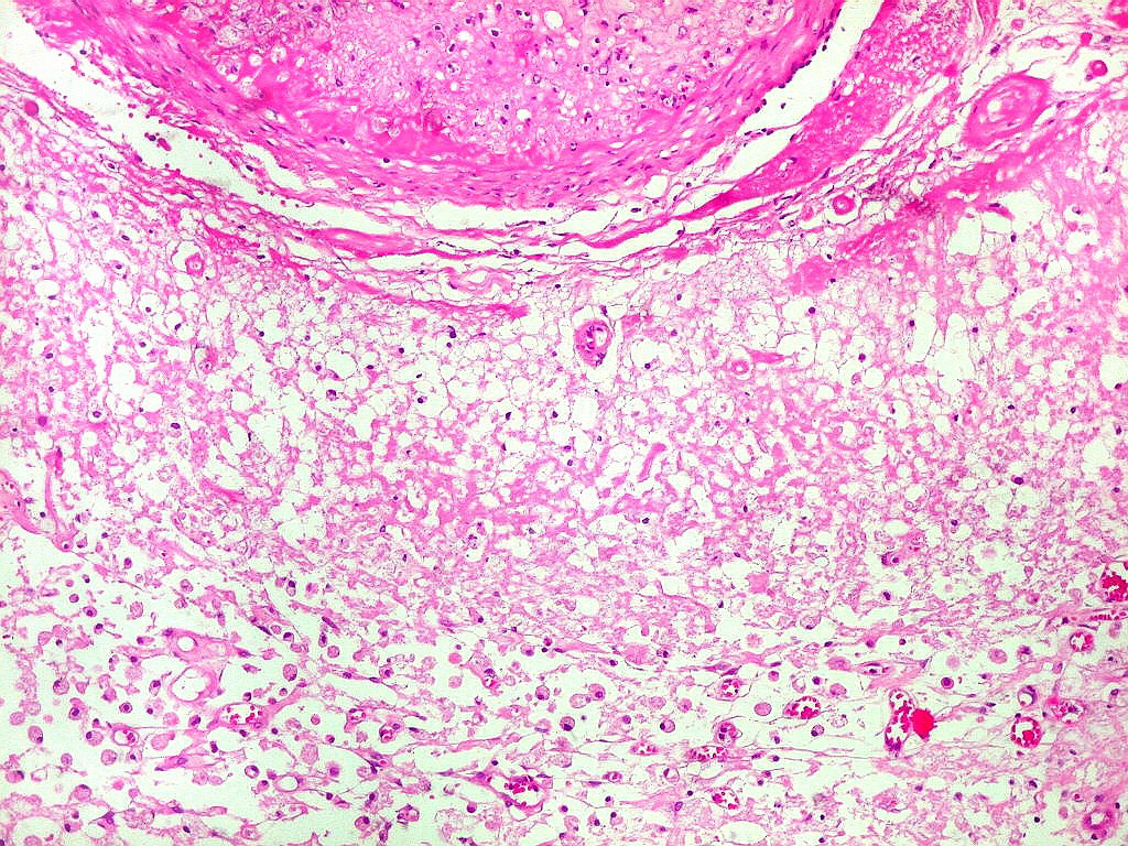 Necrose é um tipo de morte celular que pode ocorrer em plantas e animais